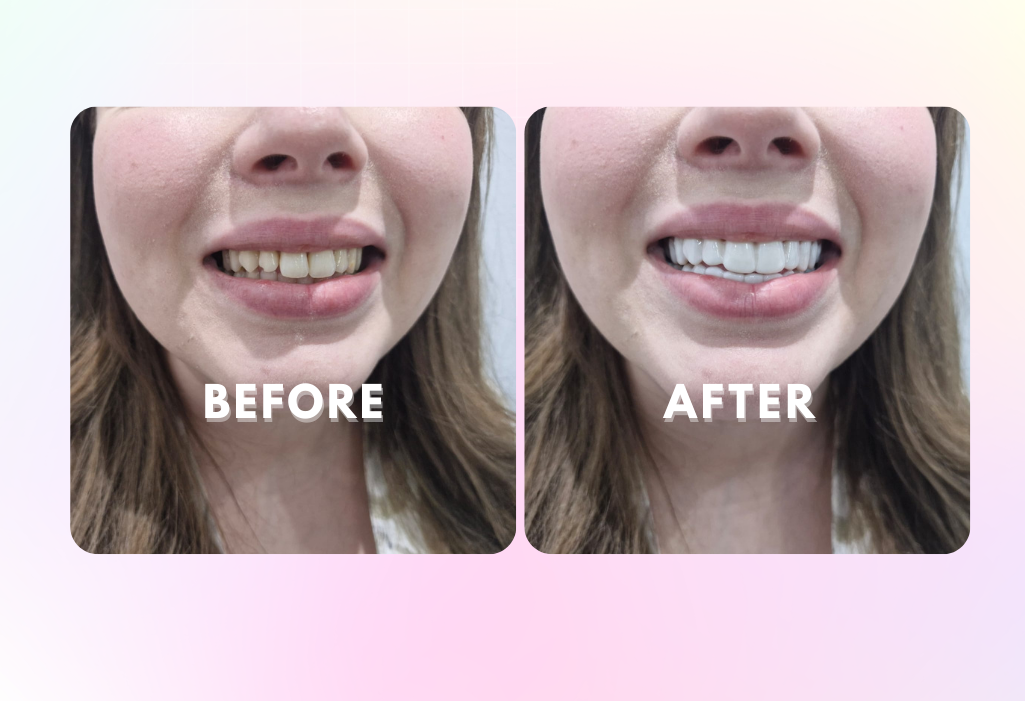 Looking for the Amazing Snap-On Veneers? Here’s Why Pioneers Veneers S ...