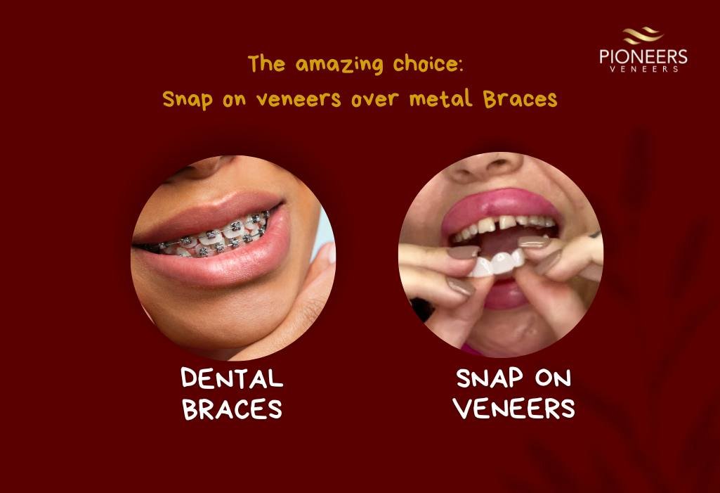 The amazing choice: Snap on veneers over metal Braces – Pioneers Veeners