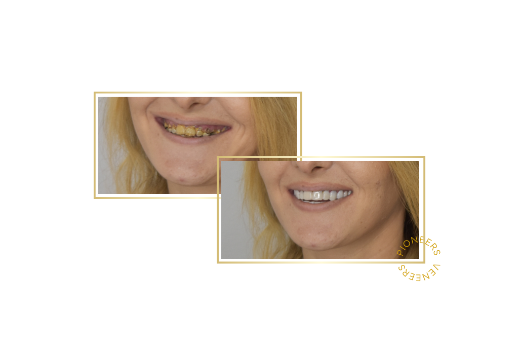 Boost Self-Confidence with a Smile Transformation | Contact Pioneers V ...