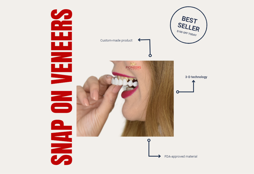 What are Pioneers Veneers No.1 Snap on veneers ? – Pioneers Veeners