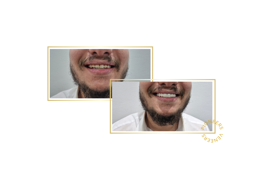 The Truth About Snap-On Veneers: Separating Pros from Cons – Pioneers ...